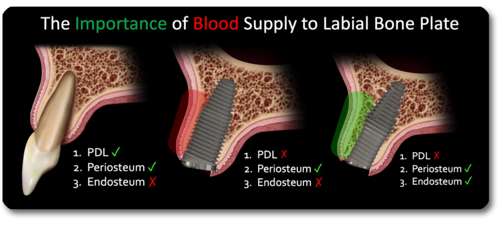 Inverta ® Implante Dental - Southern Implants Ibérica