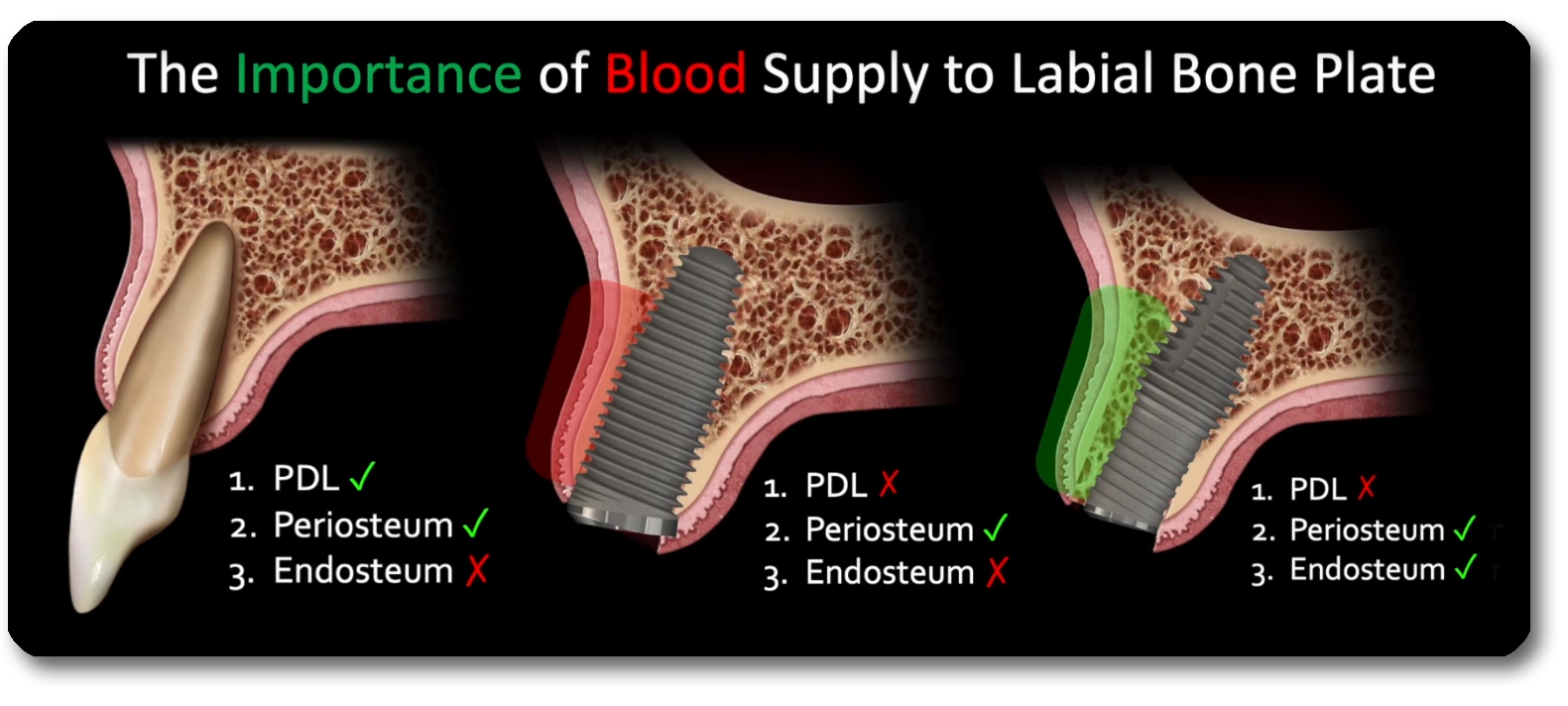 Inverta ® Implante Dental - Southern Implants Ibérica